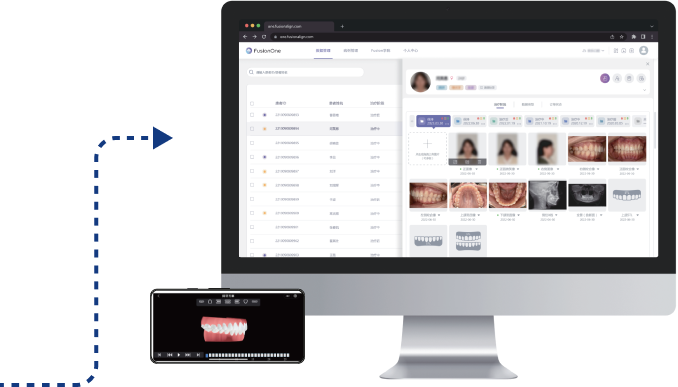 FusionScanner口腔数字印模仪 | 朗视正畸
