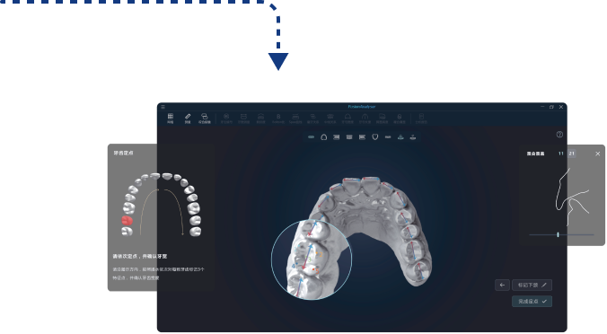 FusionScanner口腔数字印模仪 | 朗视正畸